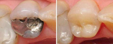 Dental inlays and onlays - Precision Dental Care