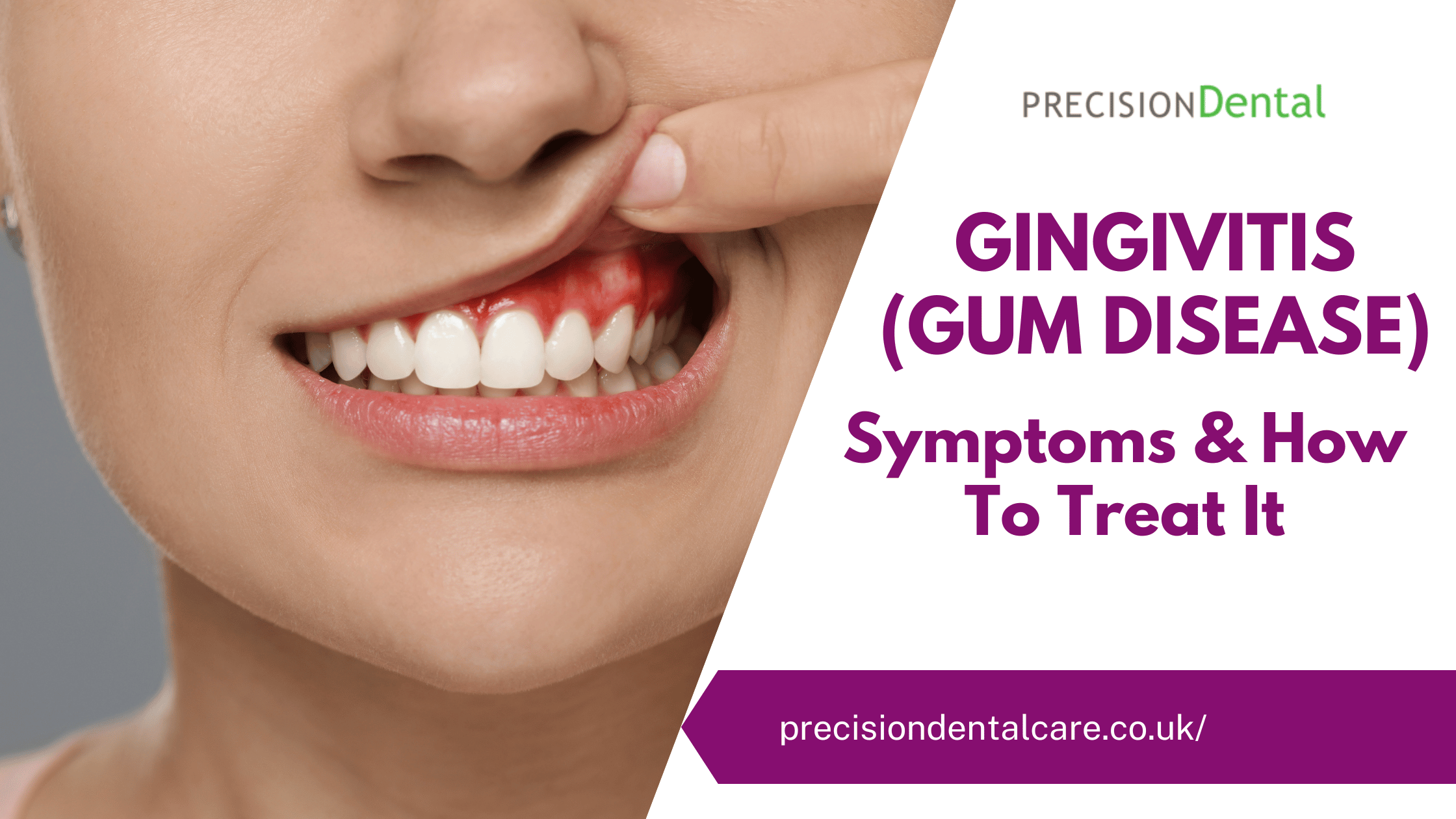 Gingivitis (Gum Disease): Symptoms & How To Treat It - Precision Dental Care
